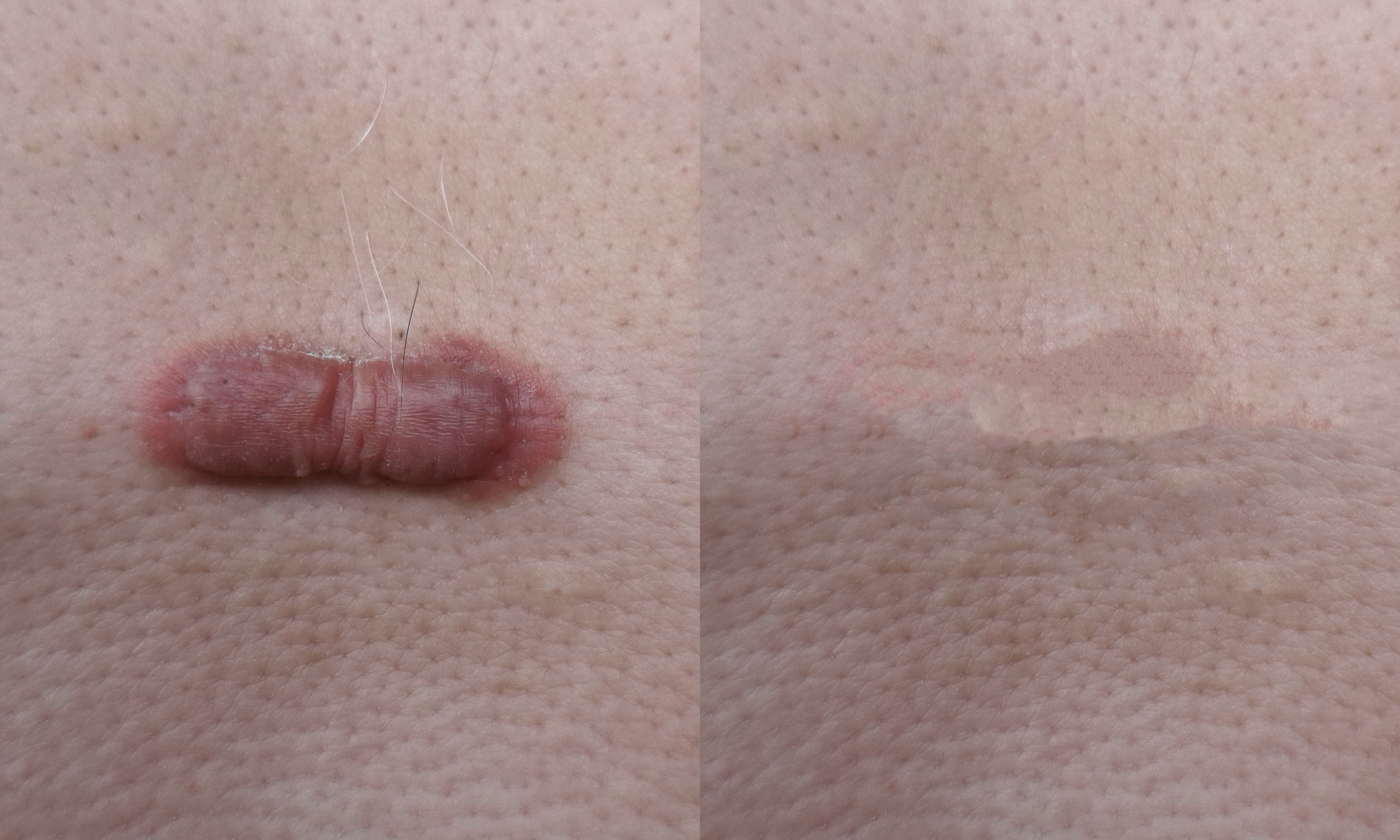 Injection for Keloid Scar or Cyst – Jennifer Baron, MD